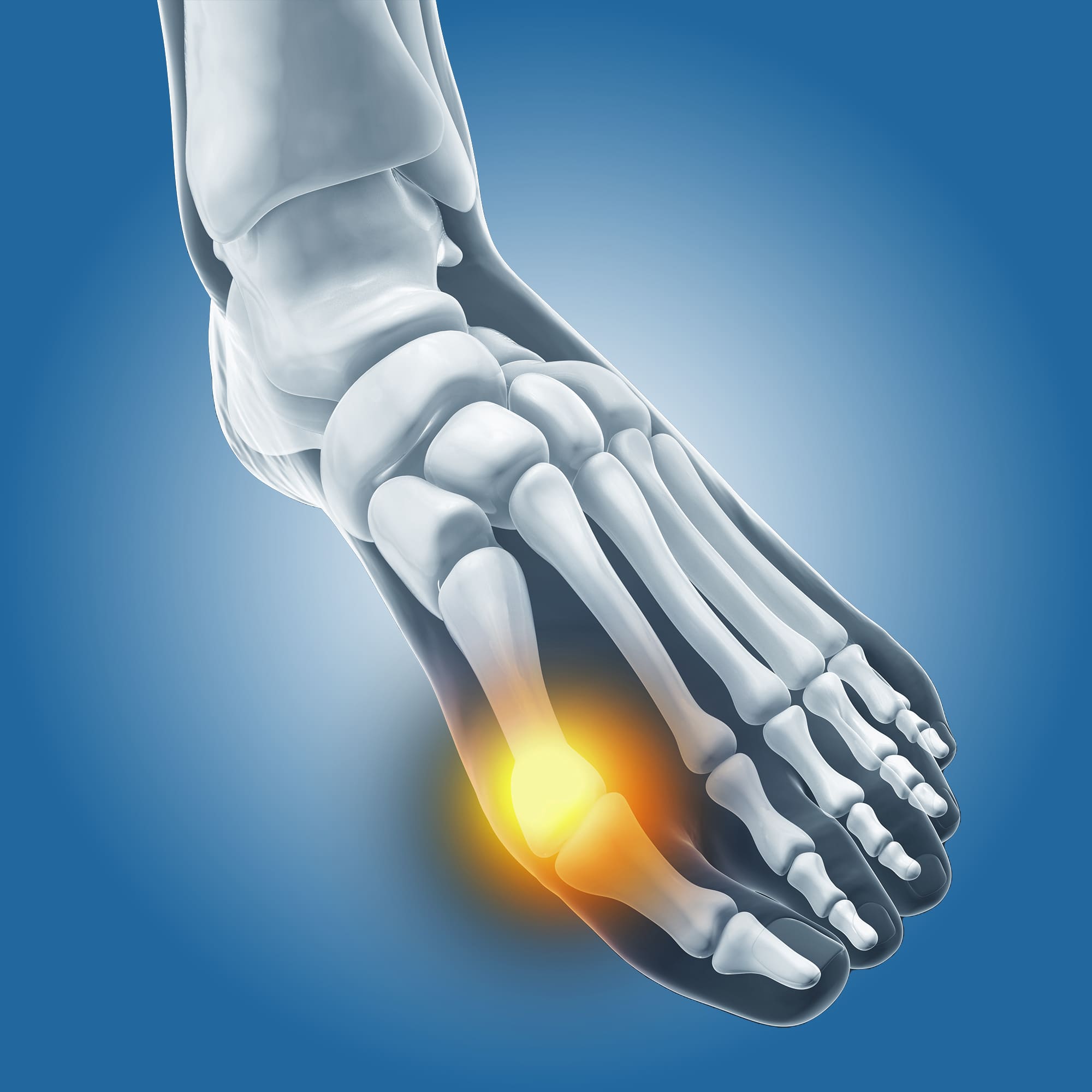 Hallux Valgus Correction - Vanni Strigelli