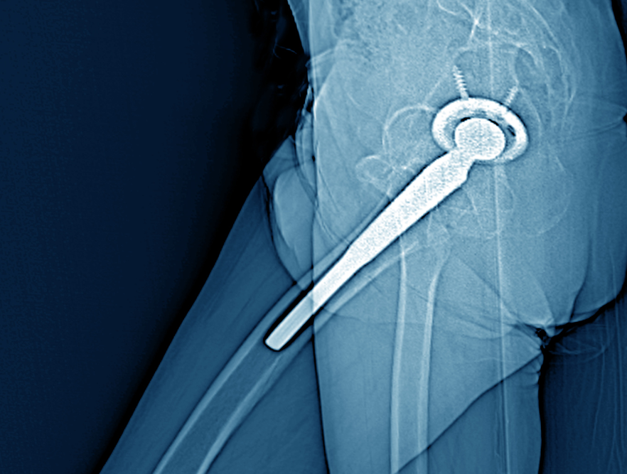 Hip Surgeon Insights: Mini-Invasive Hip Replacement for Swift Recovery ...